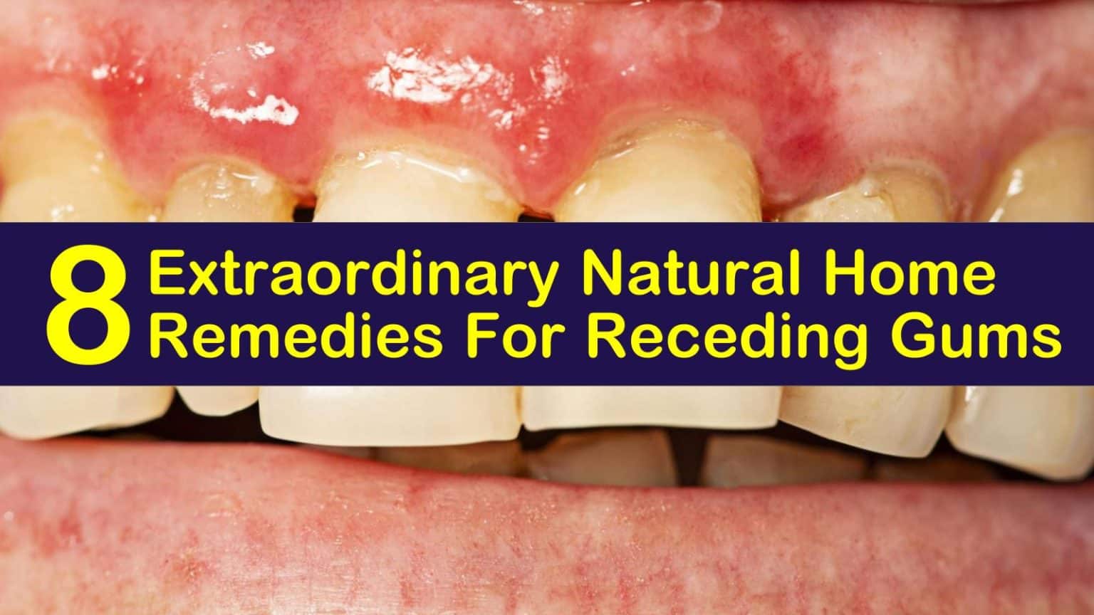 8 Extraordinary Natural Home Remedies For Receding Gums